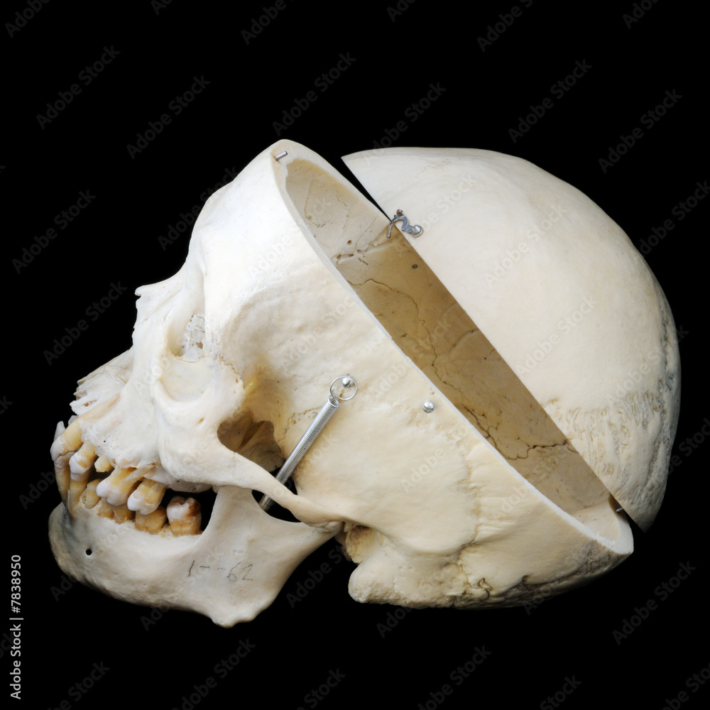 Side view of real human skull with skullcap askew Stock Photo | Adobe Stock