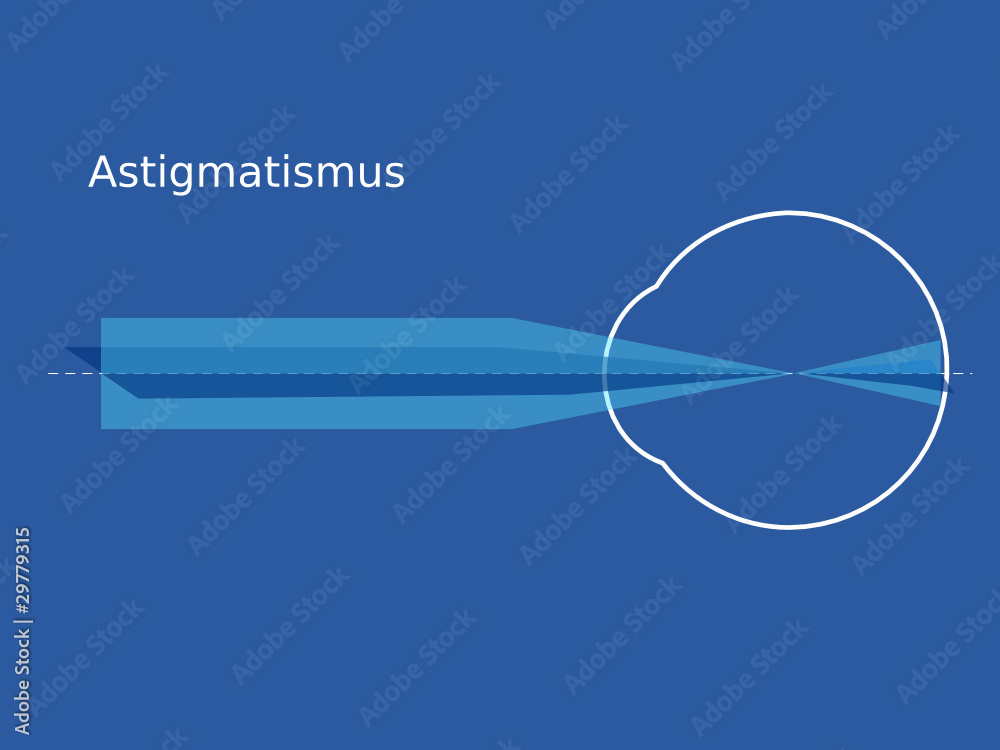 Schema Astigmatismus Stock Vector | Adobe Stock