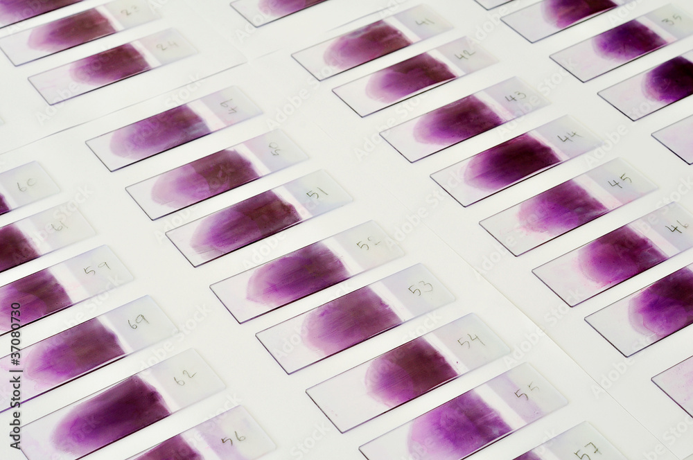 Blood film Stock Photo | Adobe Stock