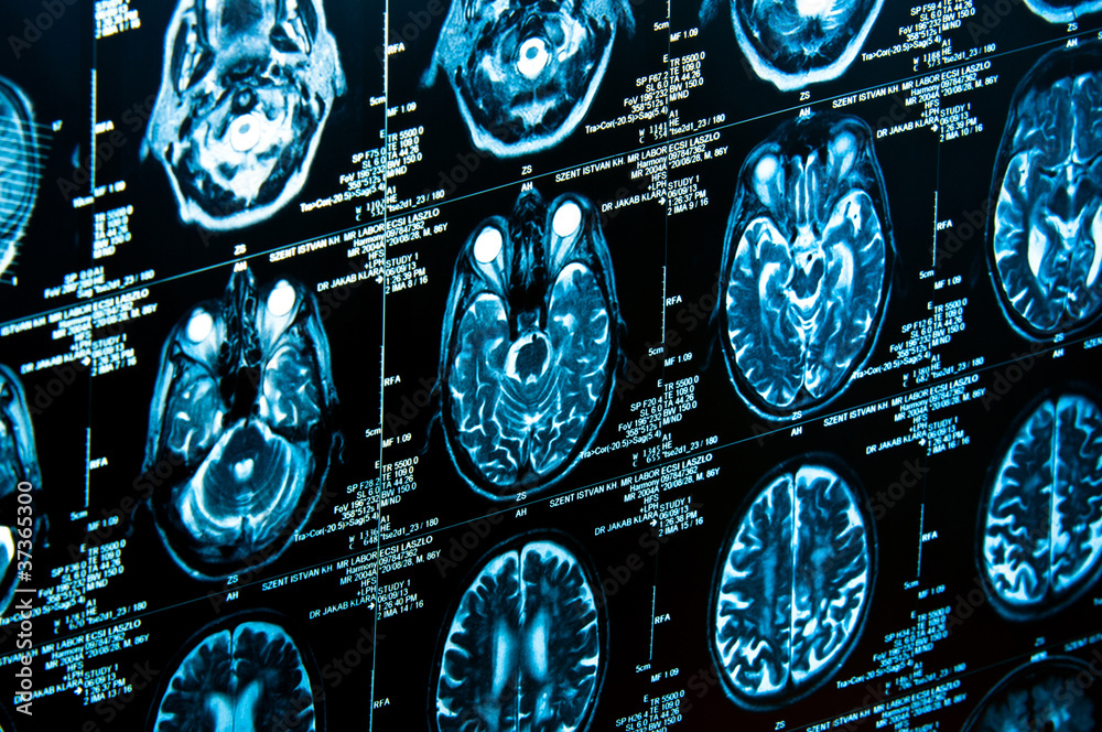 Closeup of a computer axial tomography scan (CAT scan) Stock Photo ...
