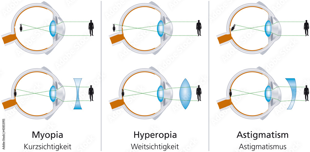 The visual defects Myopia, Hyperopia and Astigmatism and how to correct ...