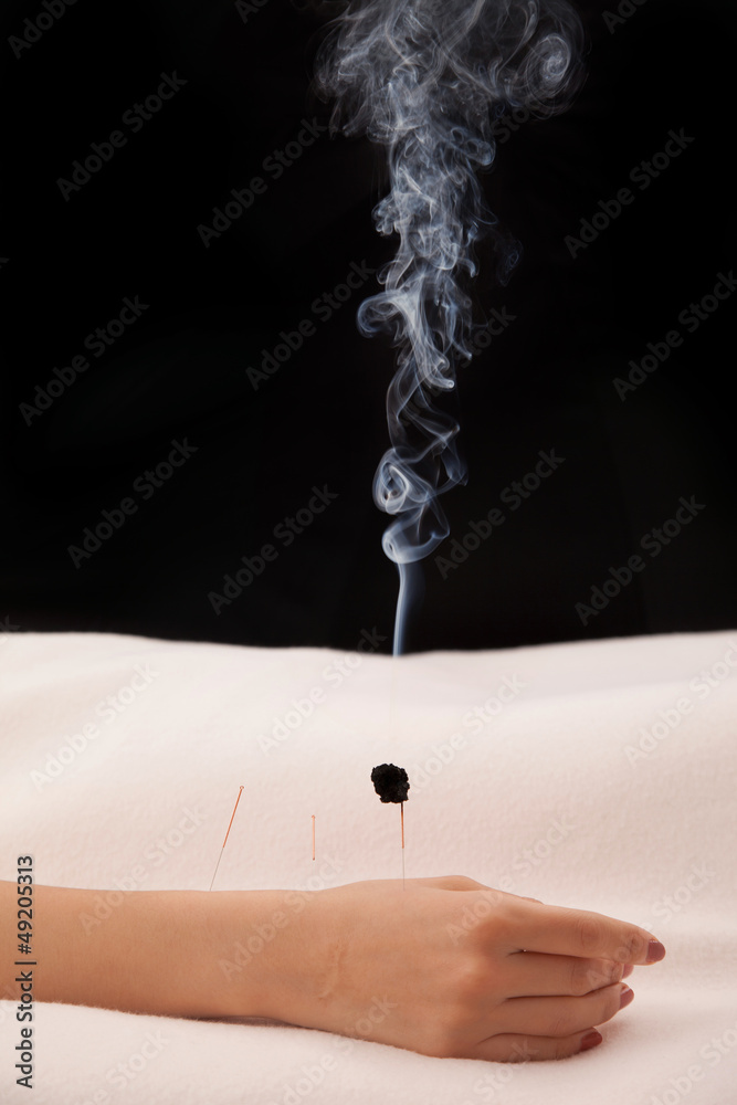 Burning acupuncture needle Stock Photo | Adobe Stock