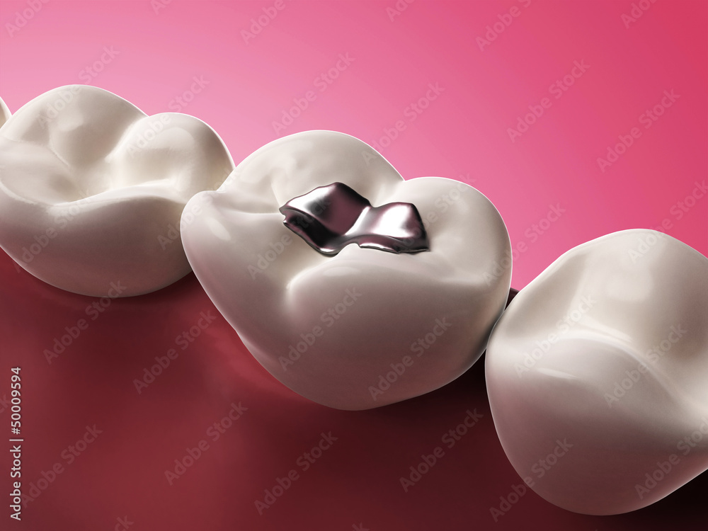 3d rendered illustration of an amalgam filling Stock Illustration ...