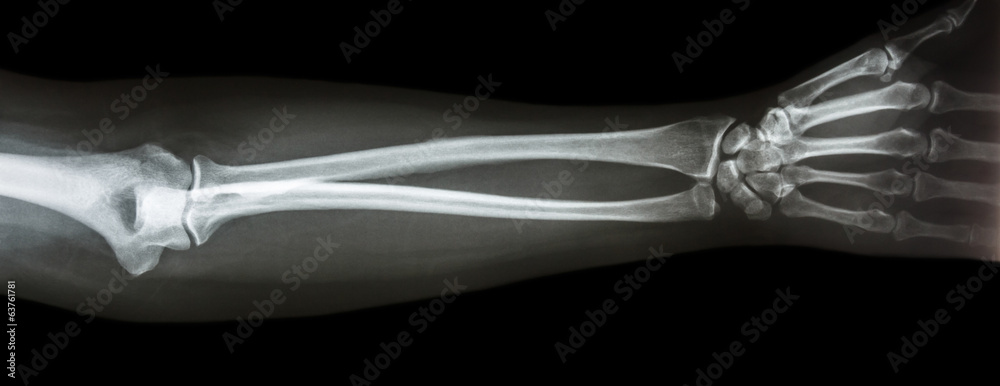 film x-ray forearm AP(antero-posterior) Stock Photo | Adobe Stock