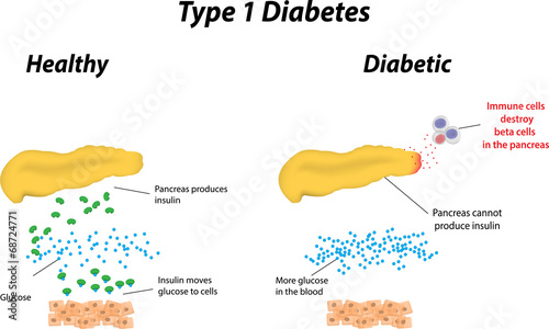 Type 1 Diabetes Labeled Diagram Stock Illustration | Adobe Stock