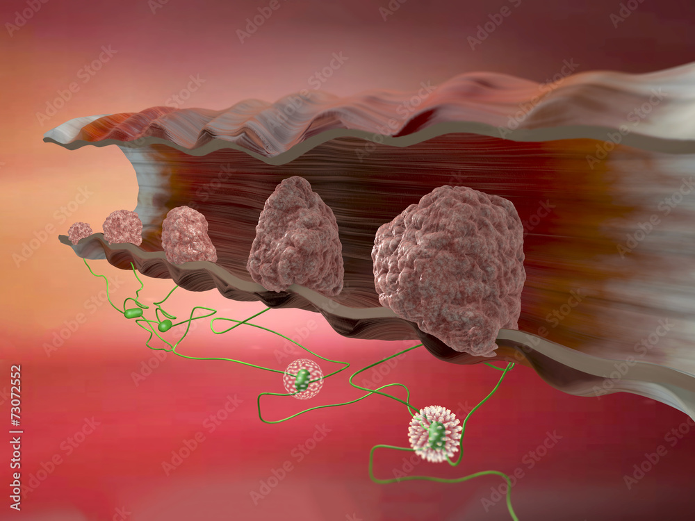Colonscopia esame colon apparato digerente Stock Illustration | Adobe Stock