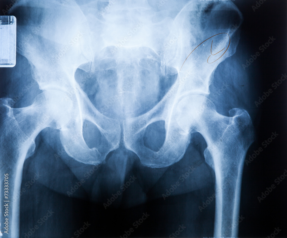 X ray MRI - Image of Spine pain and Hip bone.. Stock Photo | Adobe Stock