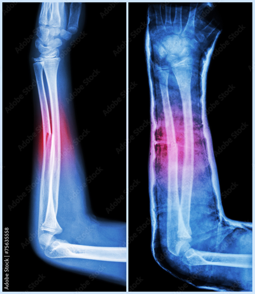 Fracture shaft of ulnar bone ( forearm bone ),splint with cast Stock ...