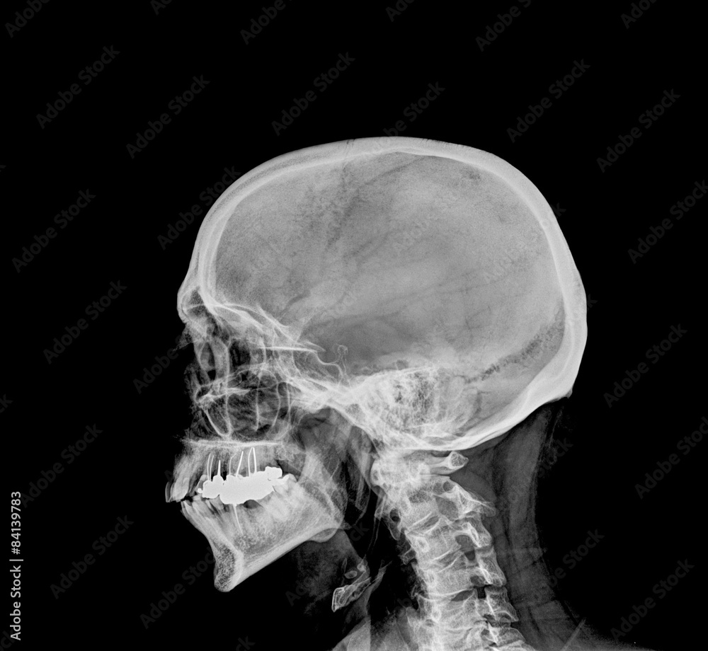 Film skull, lateral view Stock Photo | Adobe Stock