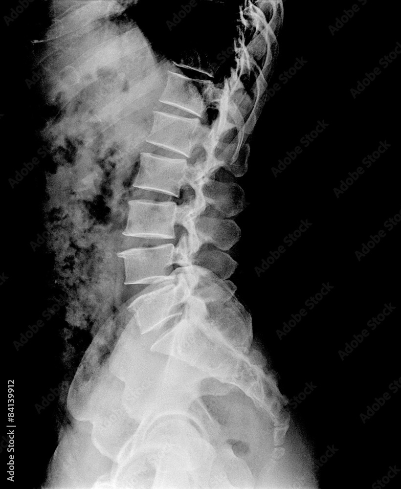 x ray of human lumbar spine lateral Stock Photo | Adobe Stock