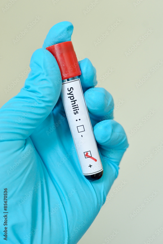 Blood sample with syphilis (Treponema Pallidum) positive Stock Photo ...