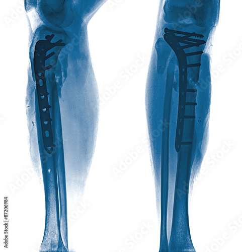 film leg AP/lateral : show fracture shaft of tibia and fibular (leg's ...