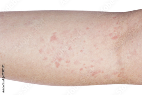 Allergic rash on arm - Buy this stock photo and explore similar images ...