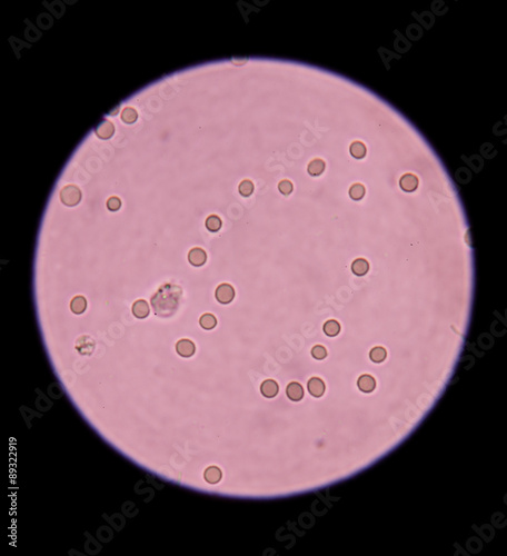 fresh red blood cells in urine specimen under microscope 400x. - Buy ...