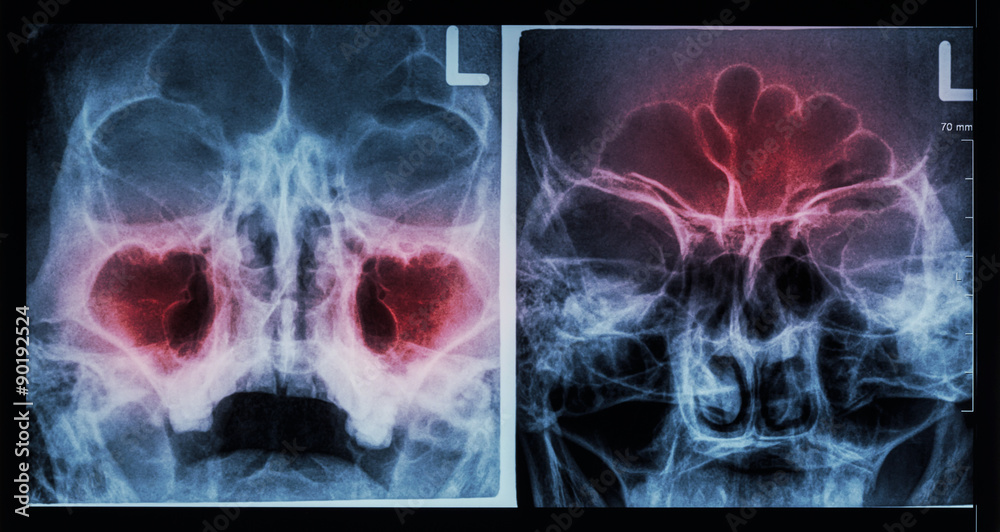 Film X-ray paranasal sinus : show sinusitis at maxillary sinus ( left ...