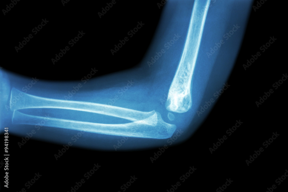 Film x-ray of child 's elbow ( normal child 's elbow ) ( Side view ...