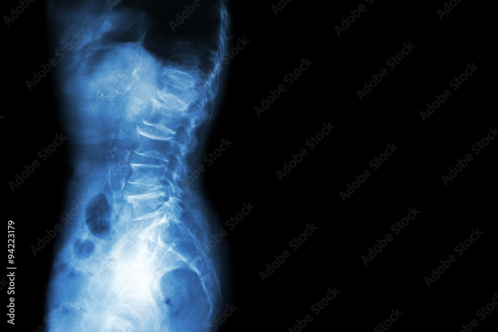 Spondylosis , Spondylolisthesis ( Film x-ray lumbo - sacral spine show ...