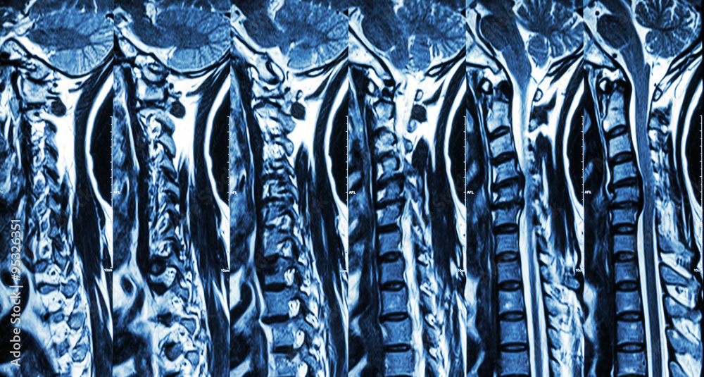 Cervical spondylosis with disc herniation ( MRI of cervical spine ...