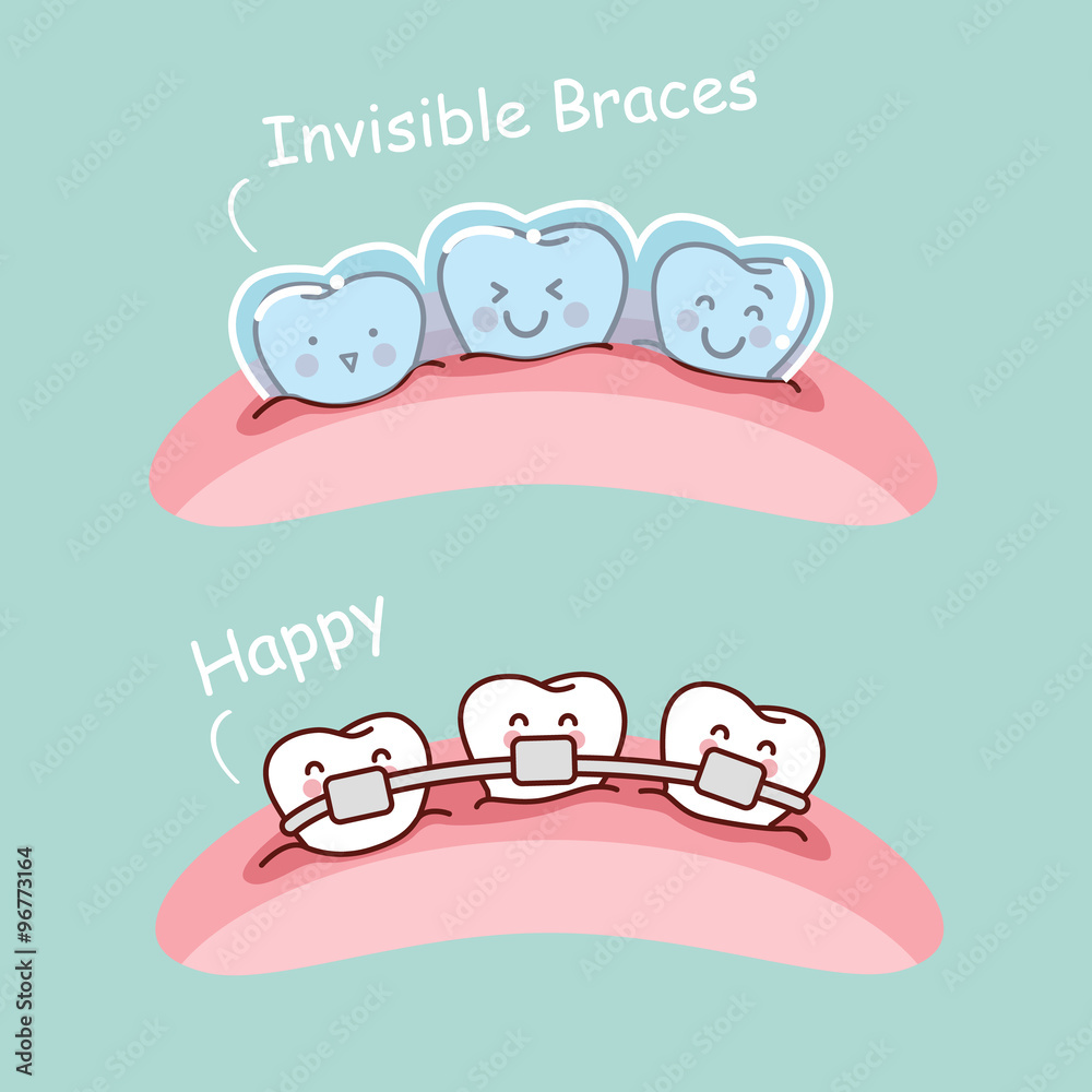 cartoon tooth with invisible braces Stock Vector | Adobe Stock