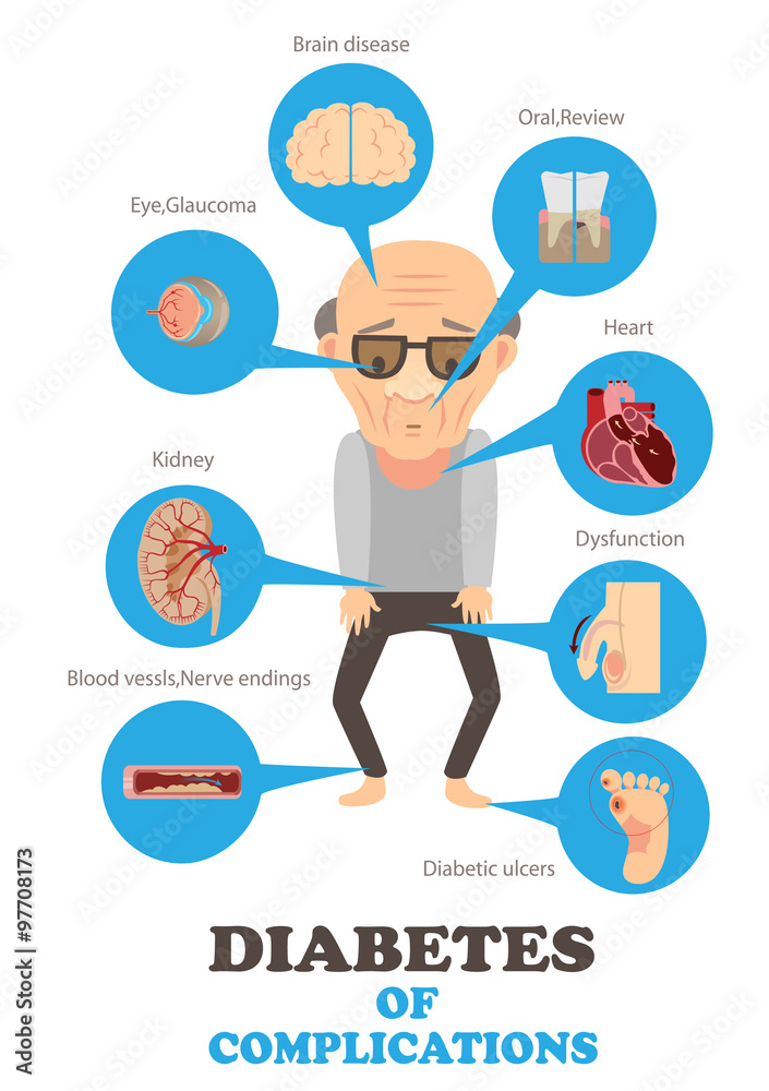 Vector de Stock Diabetes Complications infographics.vector illustration ...