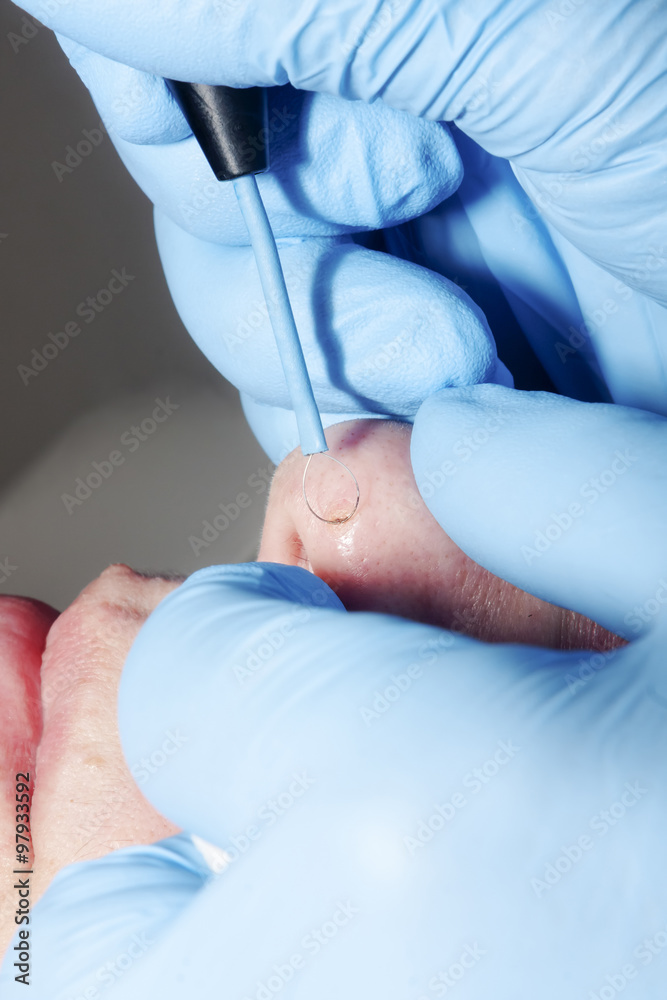 Surgeon using medical instrument for electrocoagulation to remove ...