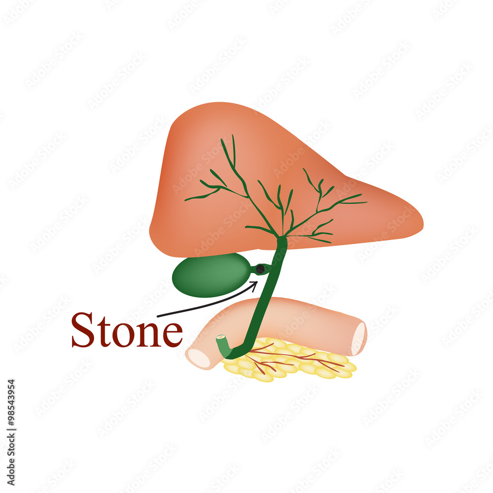 Stone bile duct. Gallbladder, duodenum, pancreas, bile ducts. Vector ...