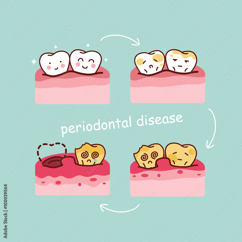 cartoon tooth periodontal disease Stock Illustration | Adobe Stock
