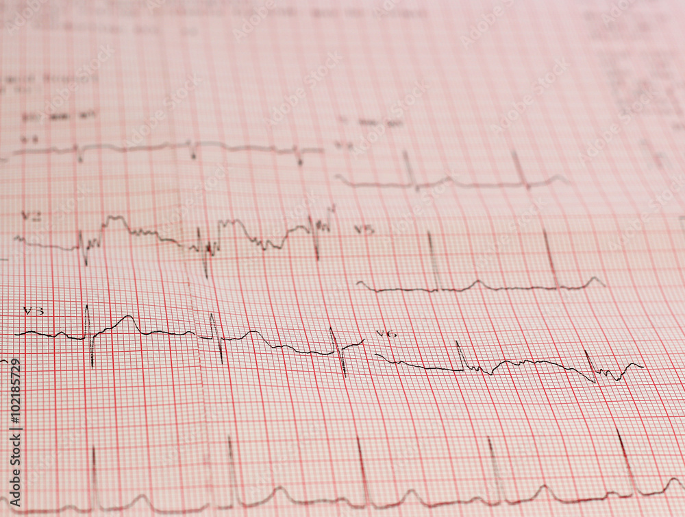 Ecg graph, electrocardiogram ecg Stock Photo | Adobe Stock