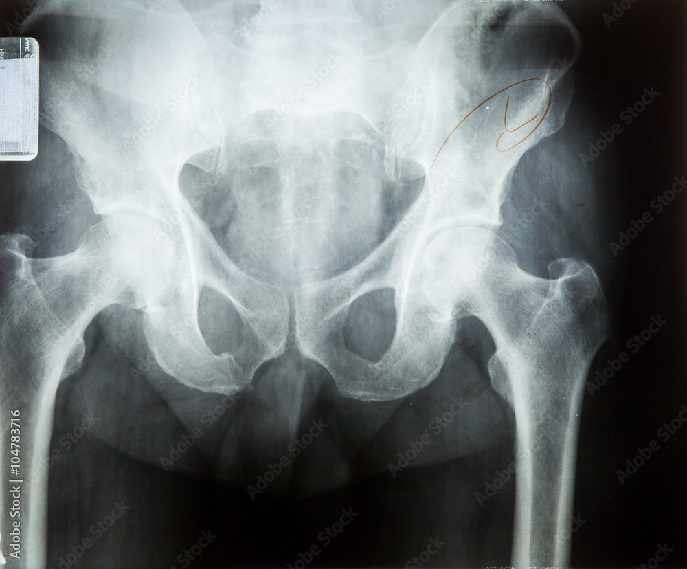 X ray MRI - Image of Spine pain and Hip bone Stock Photo | Adobe Stock