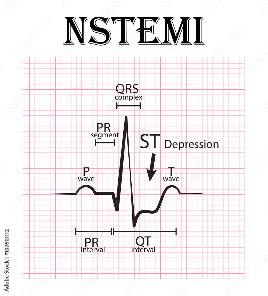 ECG of non ST elevation myocardial infarction (NSTEMI) and detail of ...