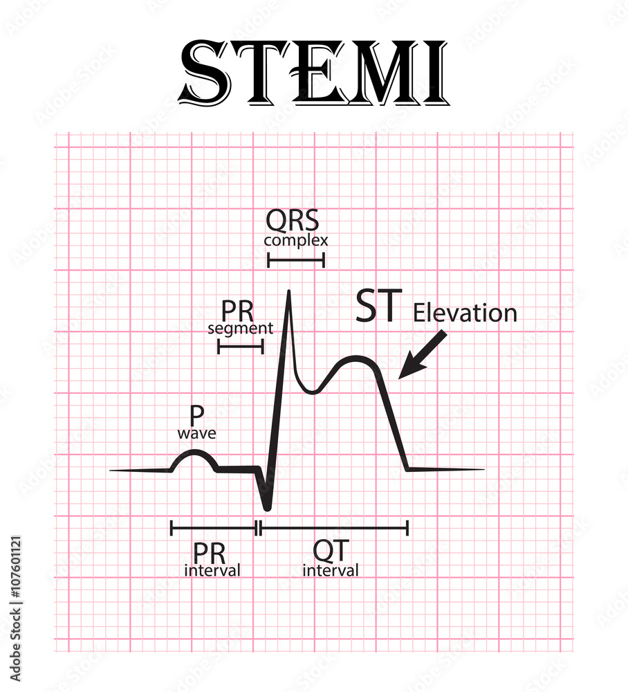 Stockvektorbilden ECG of ST elevation myocardial infarction ( STEMI ...