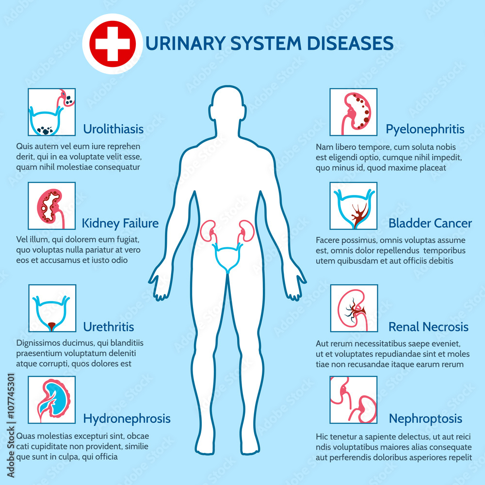 Urinary system diseases. Medical infographics of urinary system vector ...