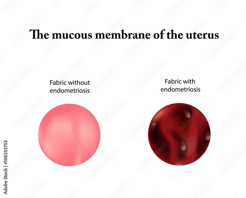 Endometriosis. Adenomyosis. The endometrium. Vector illustration on ...