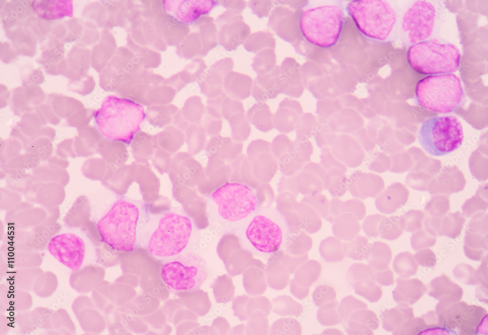 Leukemia cells Stock Photo | Adobe Stock