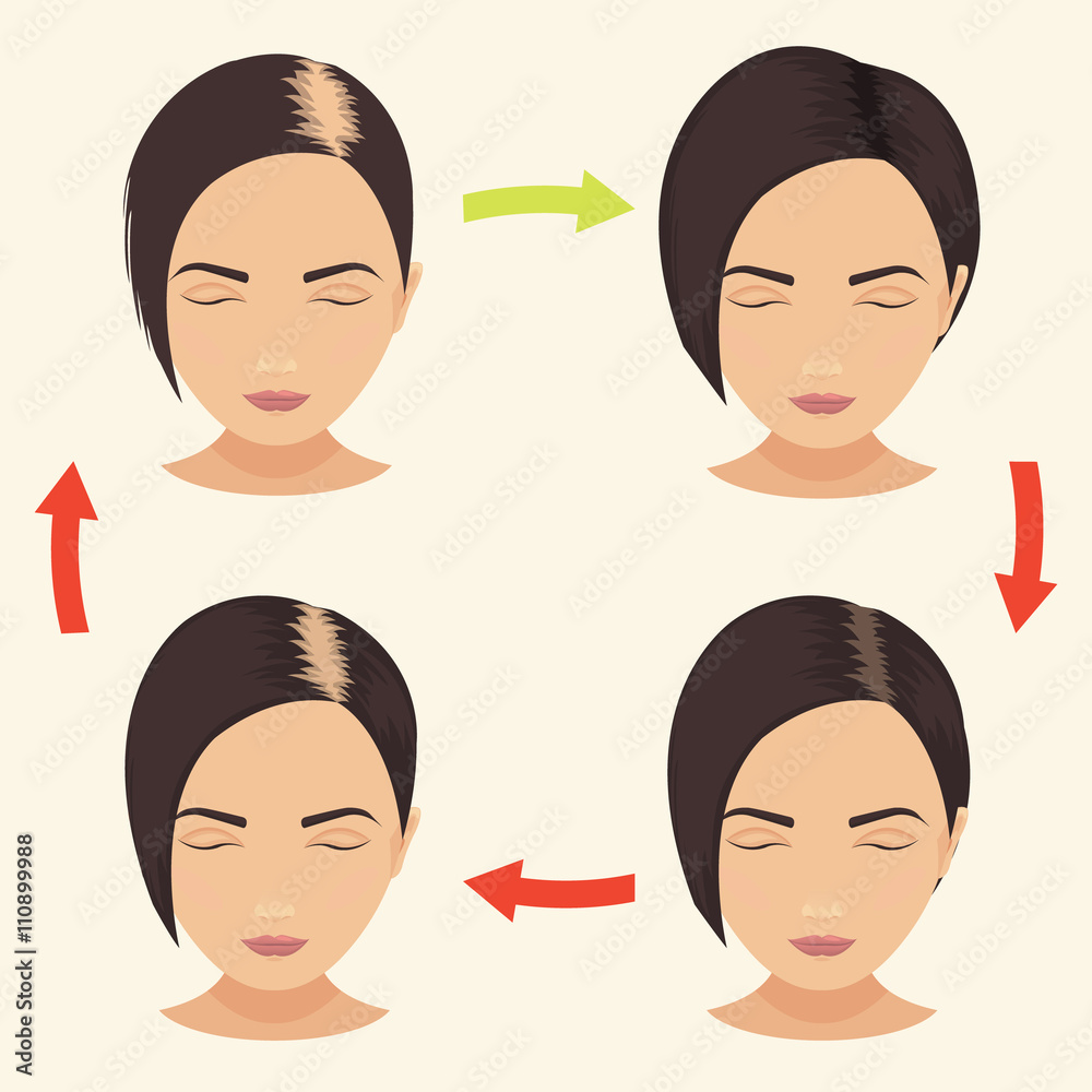 Female hair loss stages set. Woman before and after hair treatment and ...