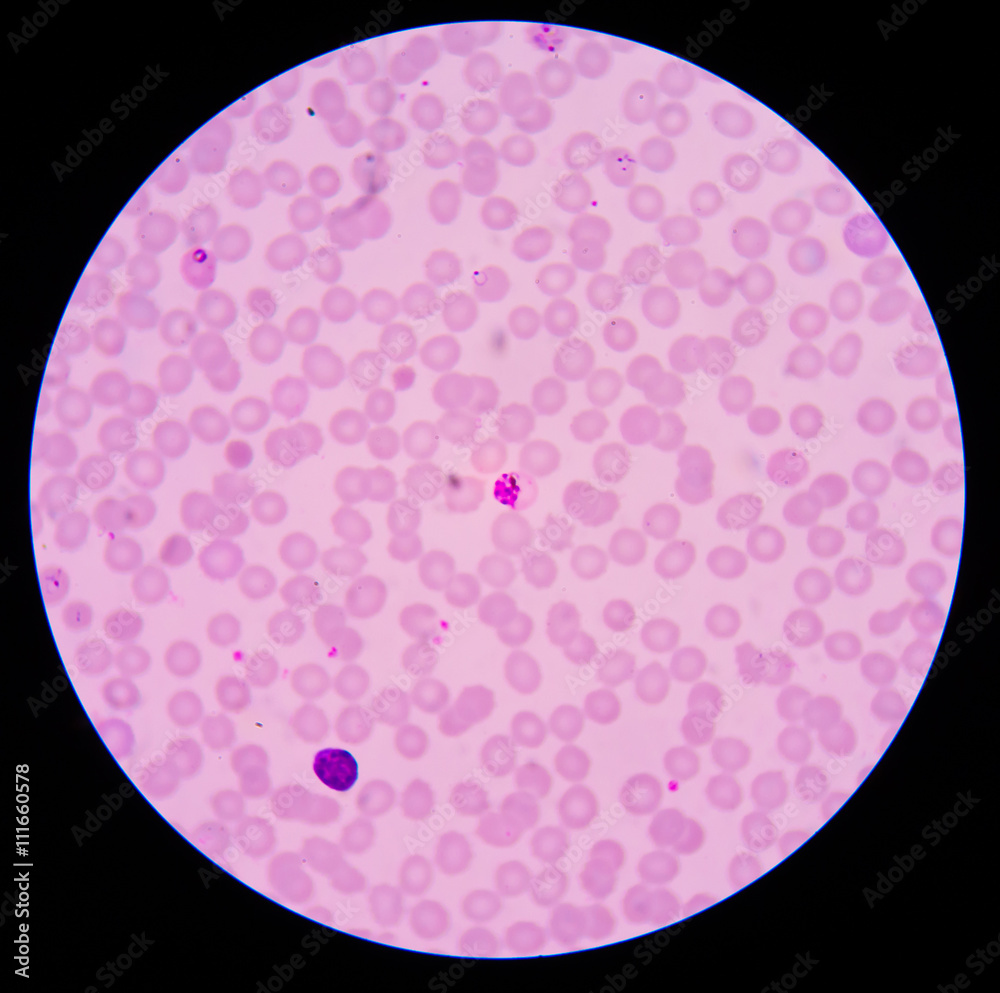 blood films for Malaria parasite.showing pink cells malaria pigm Stock ...