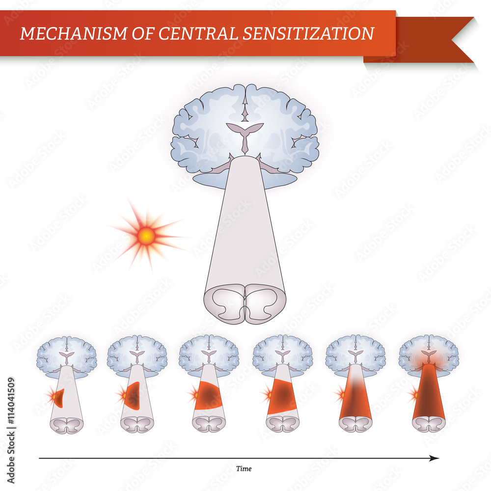 Infographic mechanism of central sensitization Stock Vector | Adobe Stock