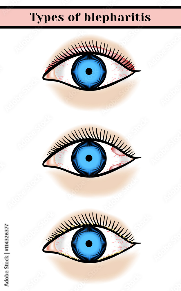 Blepharitis. Purulent, inflammatory eyes disease. Stock Vector | Adobe ...