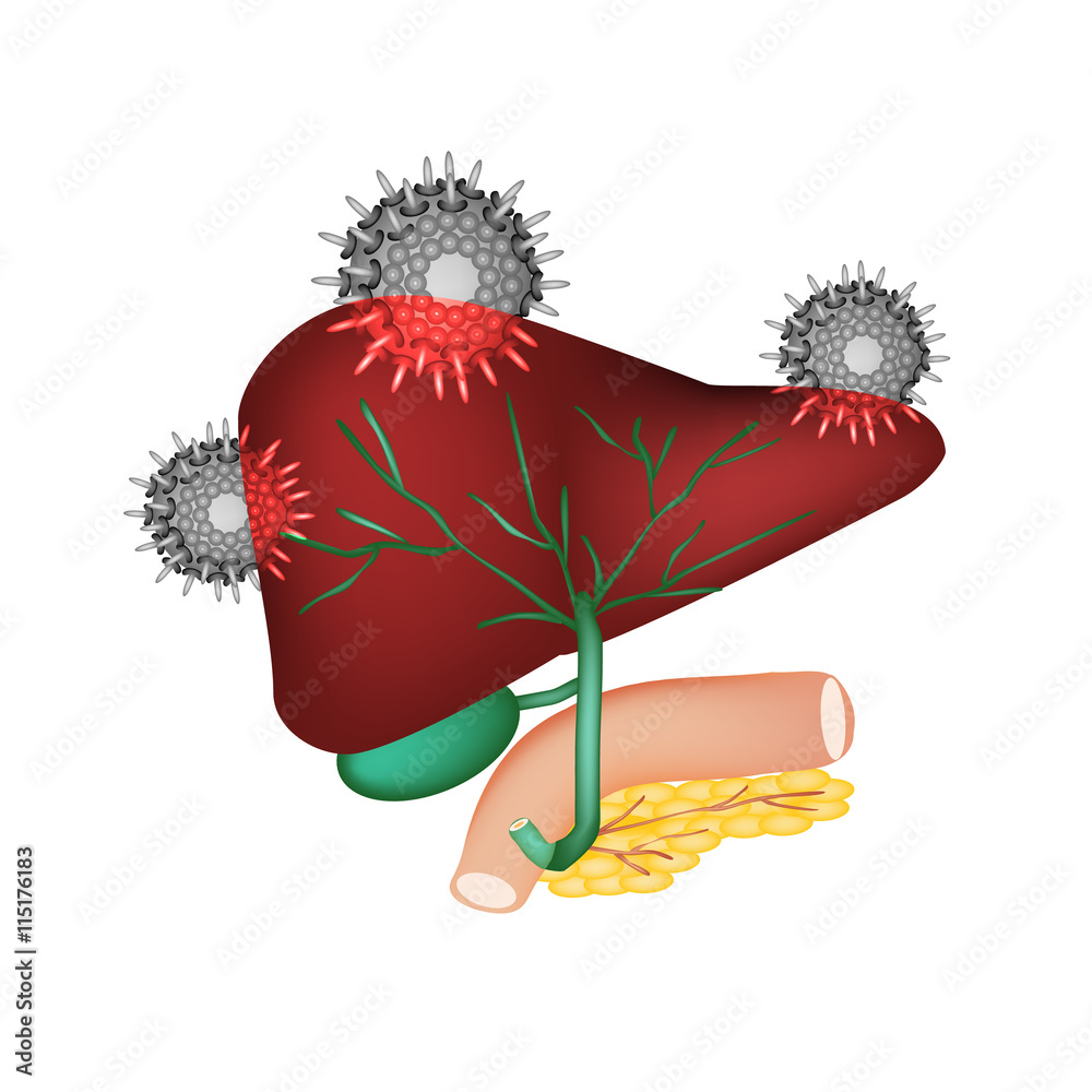 Hepatitis. The introduction of the hepatitis virus in the liver. The ...