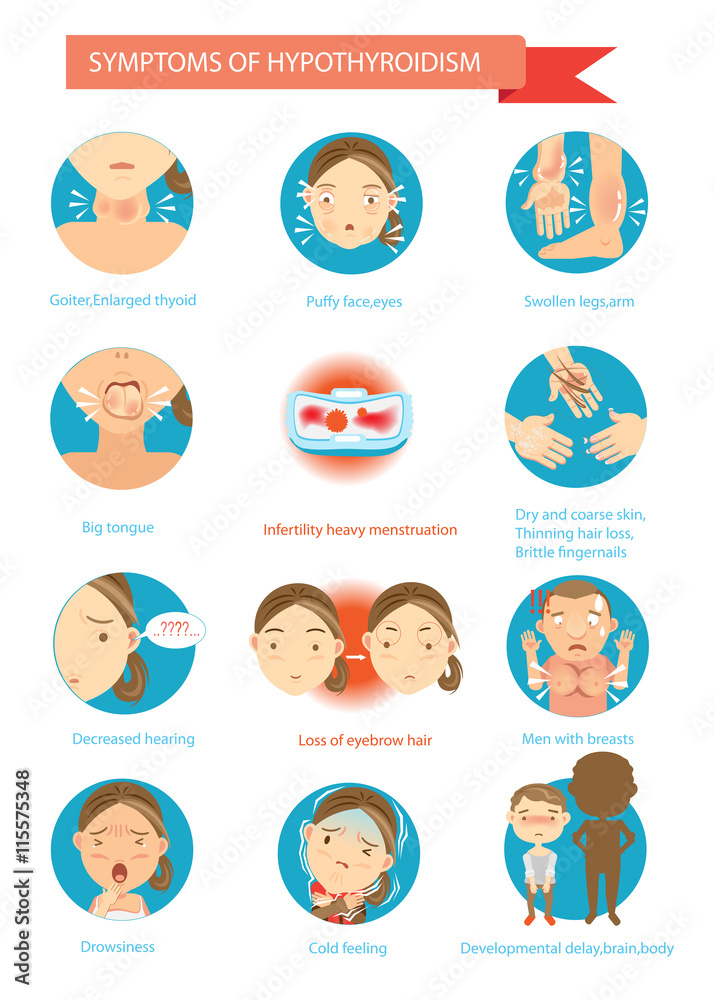 Hypothyroidism/Symptoms of the disease Hypothyroidism illustrations in ...