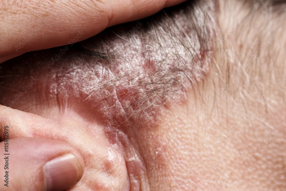 Psoriasis, psoriatic skin disease Stock Photo | Adobe Stock