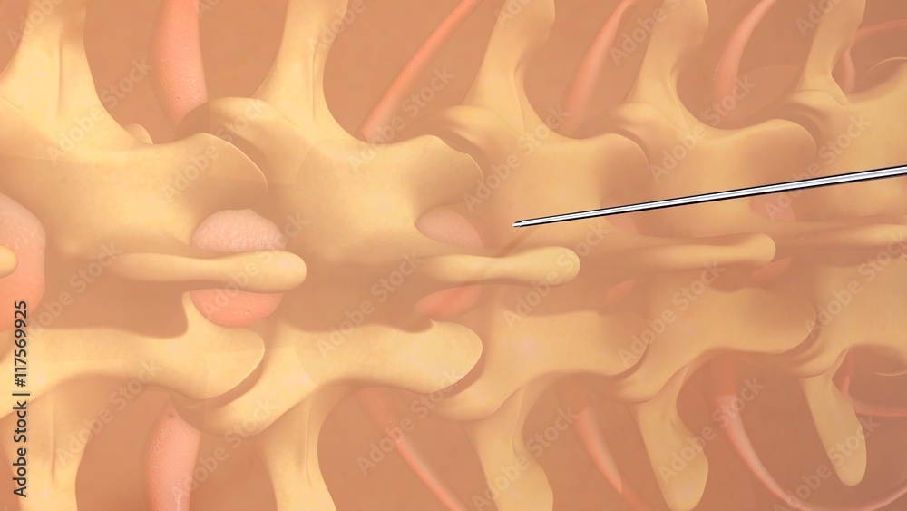 Spinal Anesthesia Stock Illustration | Adobe Stock