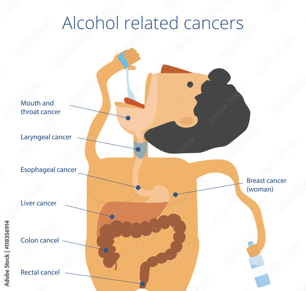 Alcohol causes seven cancers infographics. Man drinks spirits Stock ...