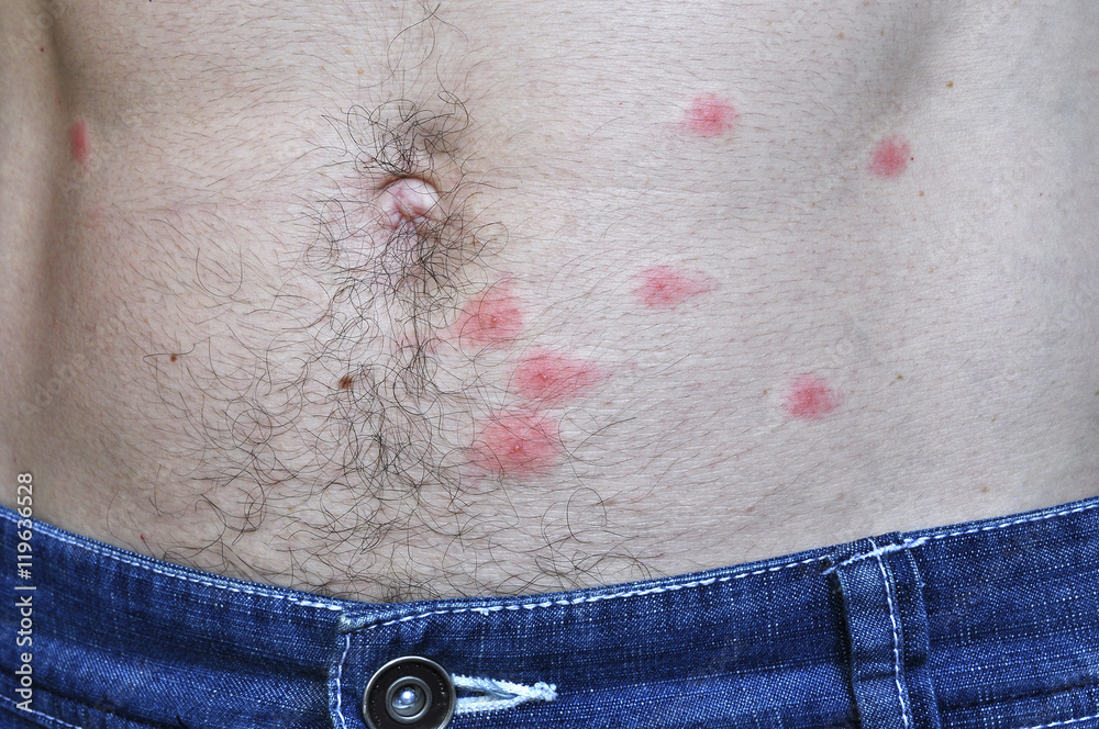 Stock-Foto „Herpes zoster shingle disease symptoms“ | Adobe Stock