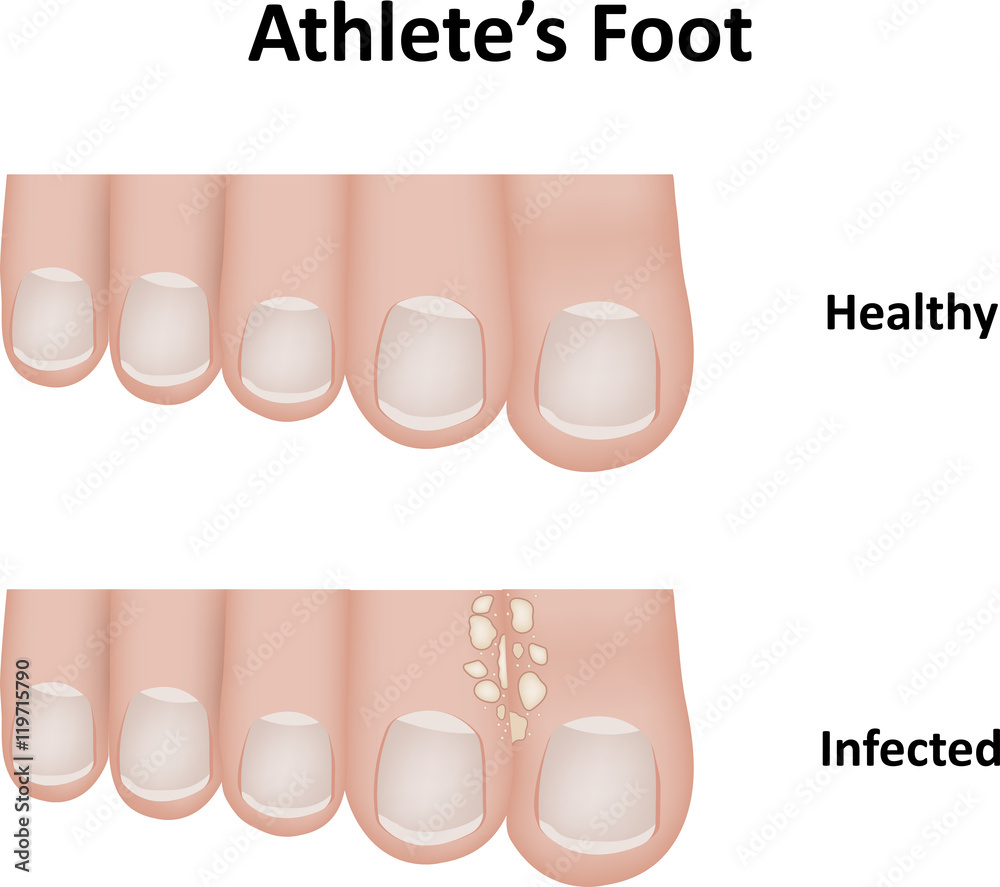 Athlete's Foot Diagram Stock Illustration | Adobe Stock