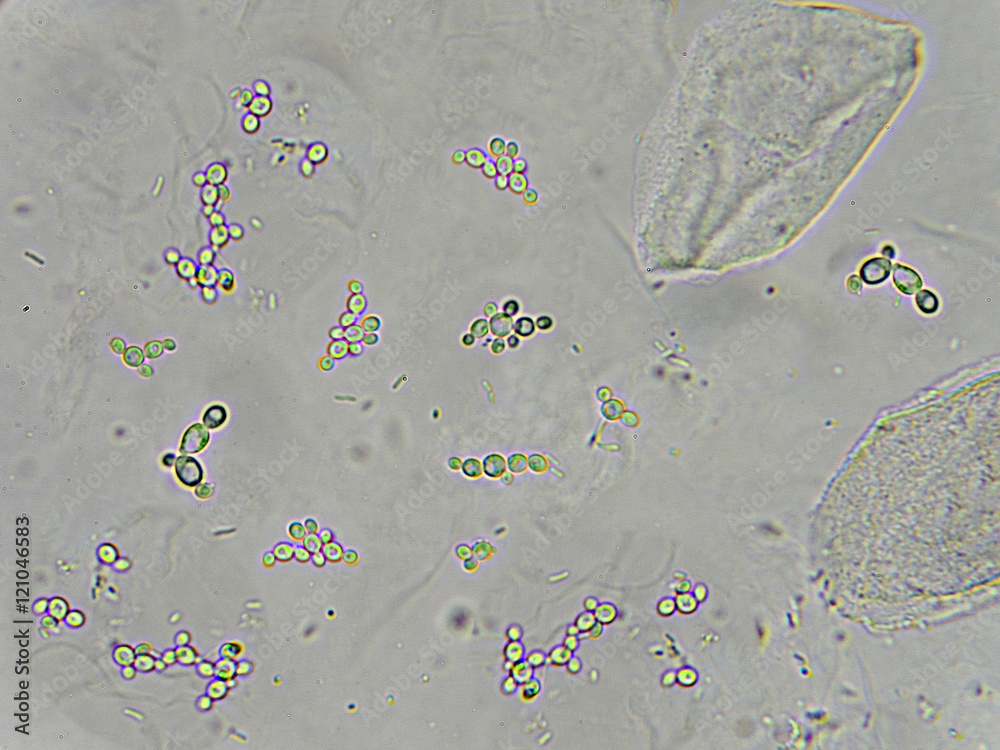Budding yeast cells in patient urine (urinary tract infections), analyze by microscope, contrast ...