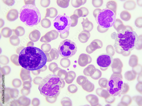 White blood cells in peripheral blood smear, Wright stain Stock Photo ...