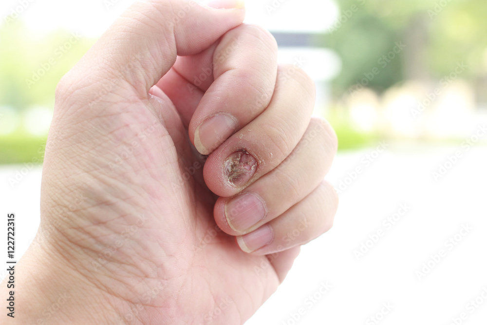 Fungal nail infection and damage on human hand. Finger with ...