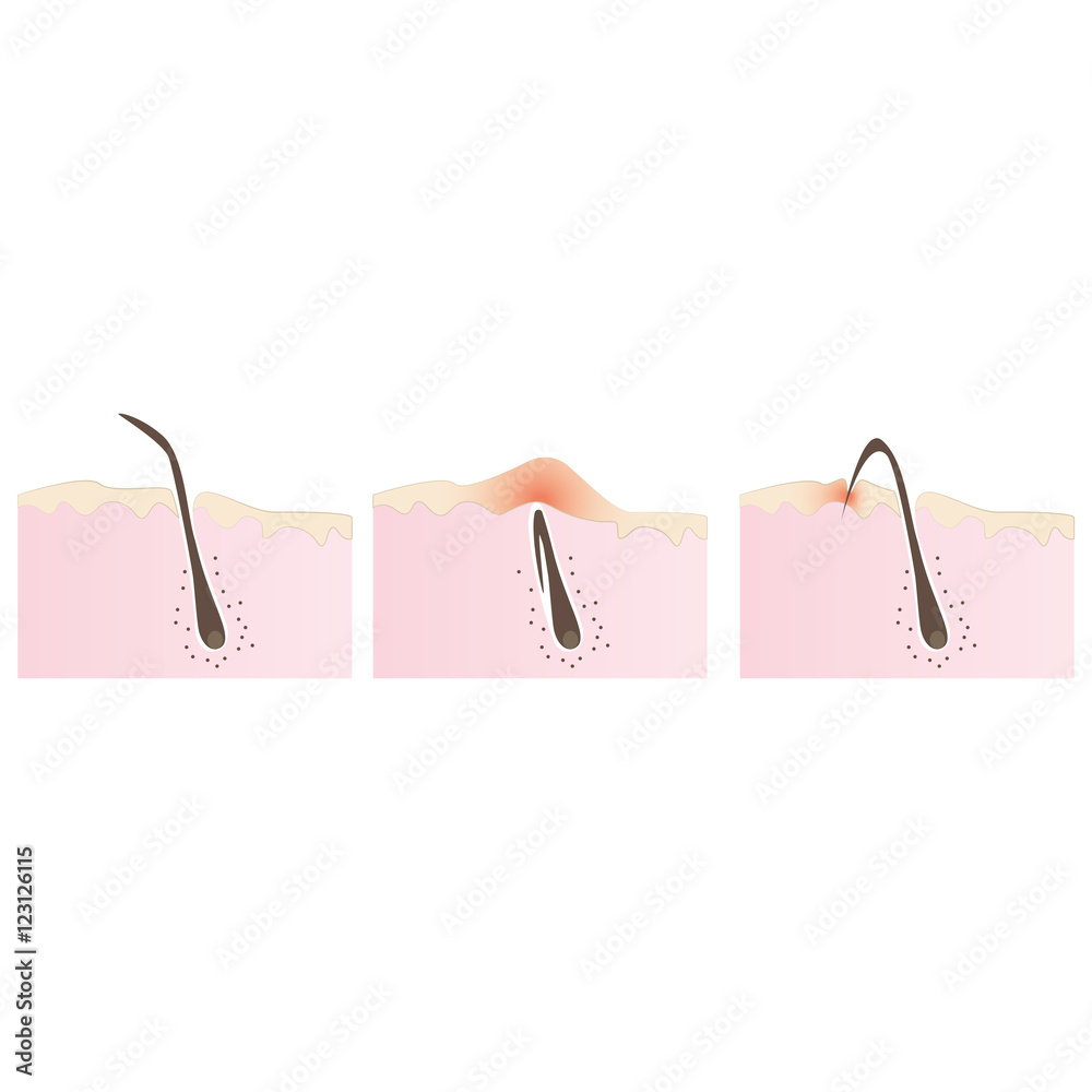 structure of the hair follicle, ingrown hairs when shaving and ...
