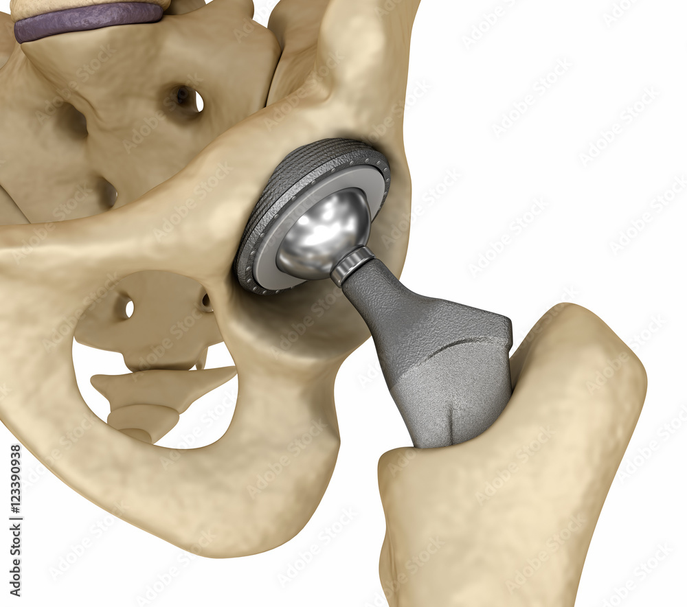 Hip replacement implant installed in the pelvis bone. Medically ...